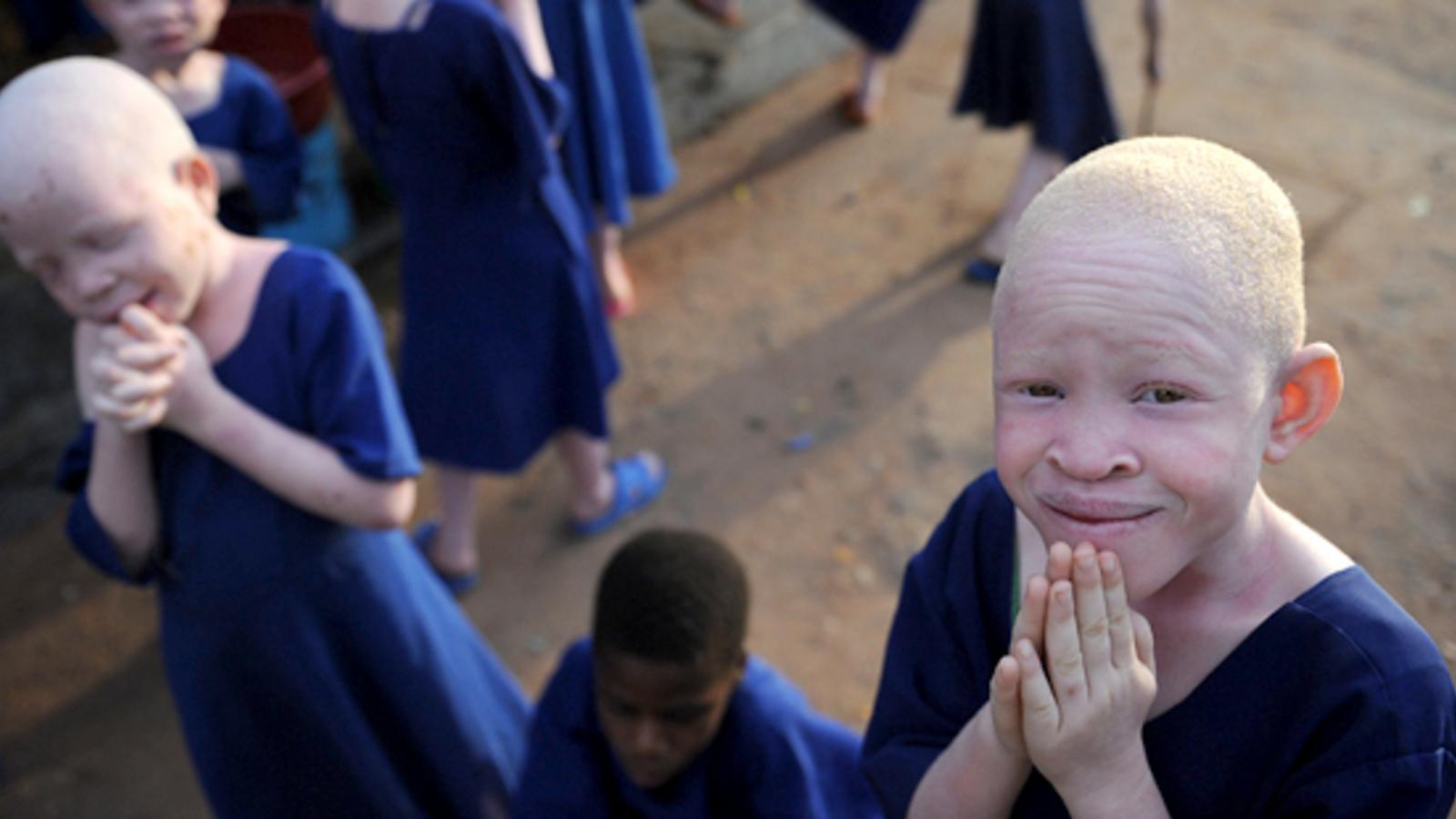 Angreifer hacken Albino Hand ab