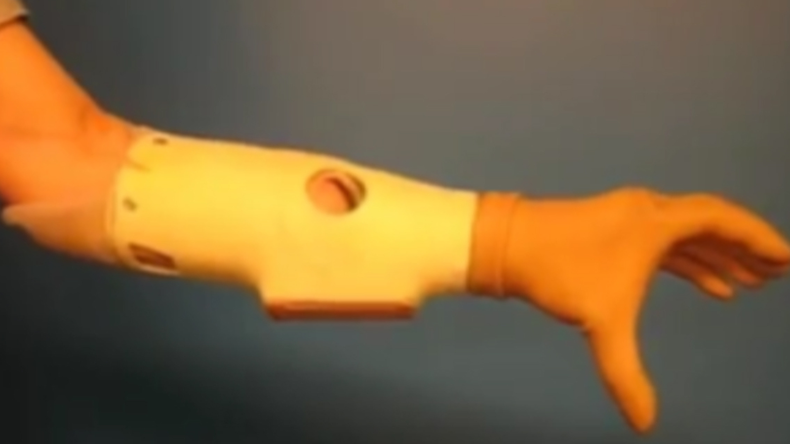 Freiwillige Arm-Amputation eines Wieners - oe24.at