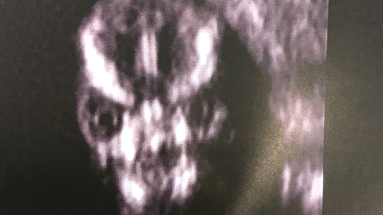 Ultraschall: Fötus sieht aus wie Lord Voldemort - oe24.at