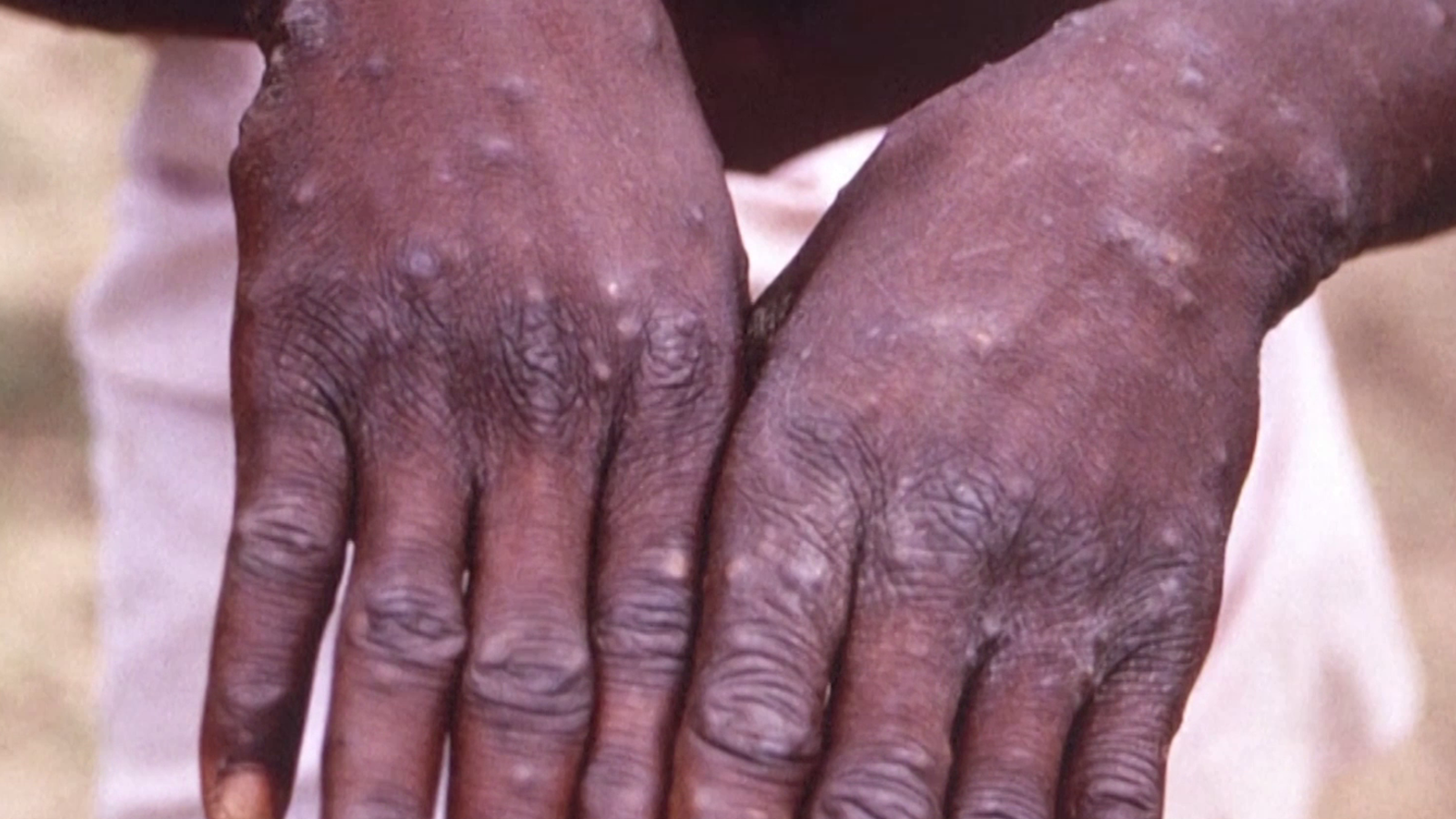 Affenpocken: In diesen EU-Ländern gibt es die meisten Fälle